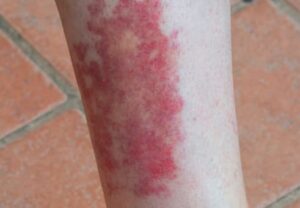 Qu’est-ce que le Disney Rash? – Le monde de Disney