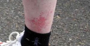 Qu’est-ce que le Disney Rash? – Le monde de Disney